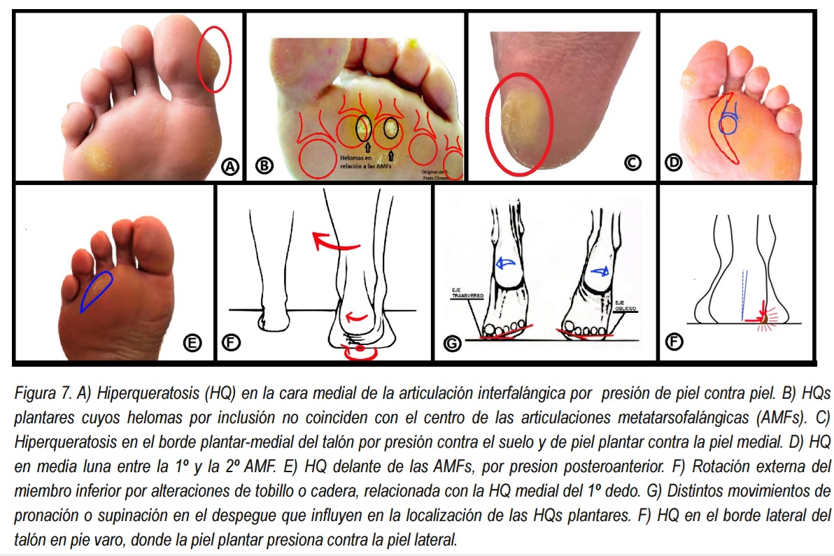 Causas de las hiperqueratosis - Podología Esencial
